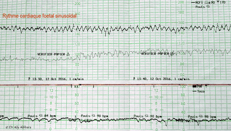 Anémie fœtale par hémorragie foeto-maternelle - 30 SA - rythme ...