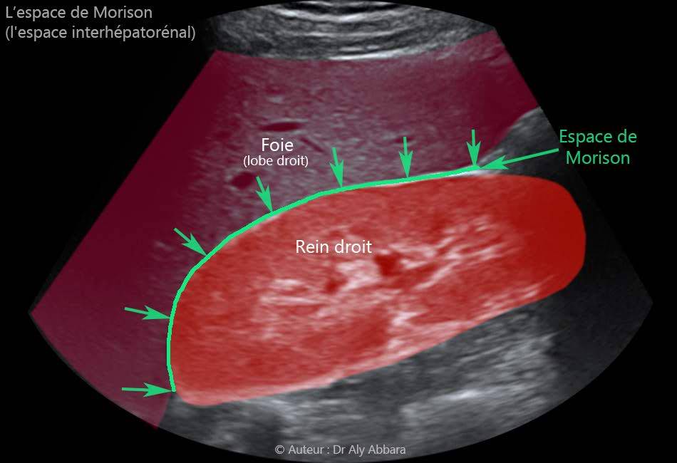 Espace de Morison (ou espace interhépatorénal) - aspect échographique
