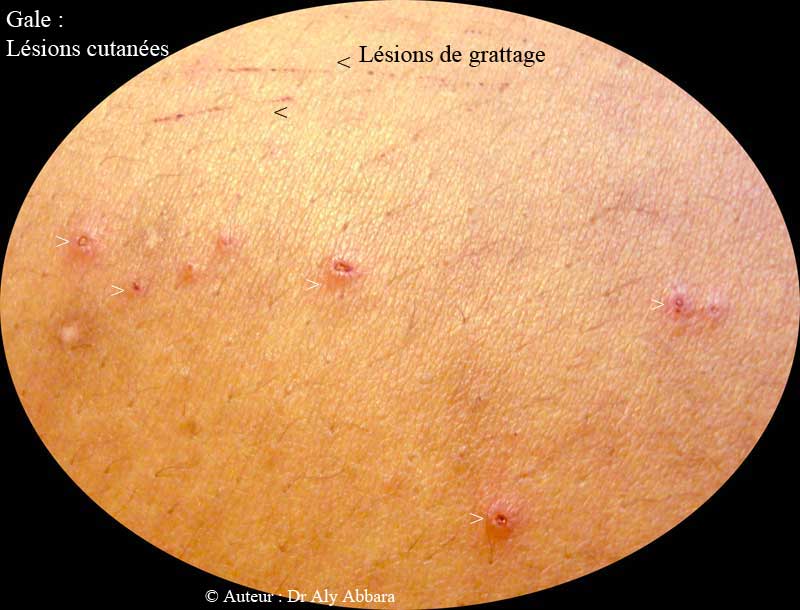 Gale - الجرب - scabies : généralités, grossesse et allaitement