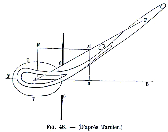 Forceps de Levret appliqué au niveau du détroit inférieur selon Tarnier
